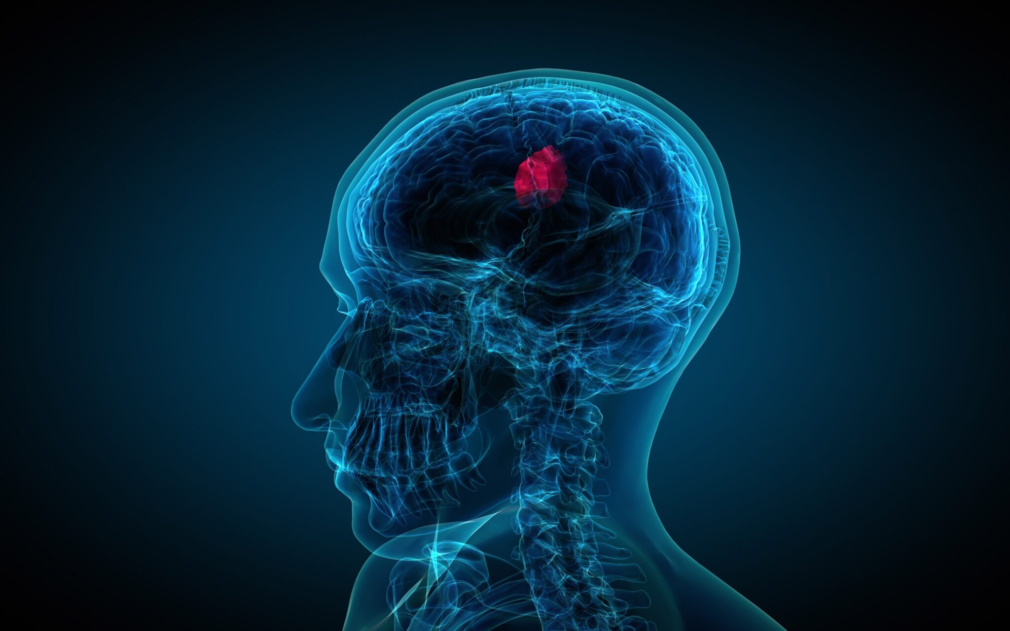 brain tumor therapy in Hyderabad - ABS Neuro Hospital